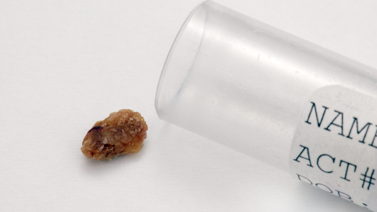 Kidney Stone Treatment in Arizona | Nephrolithiasis Doctors